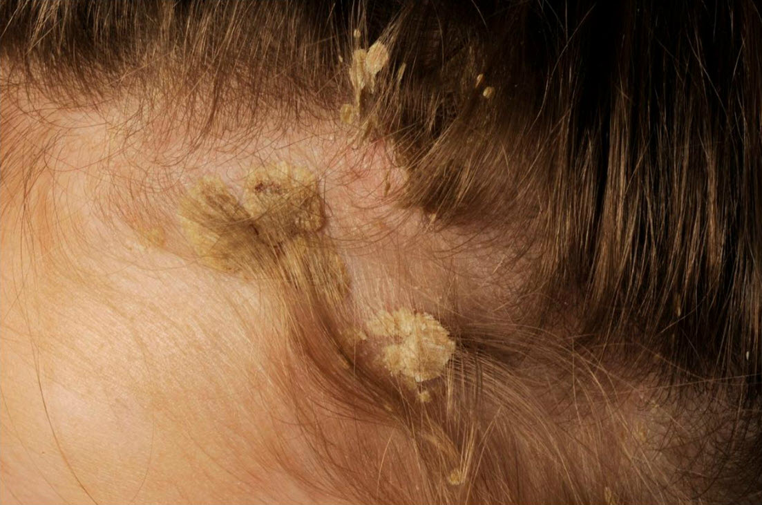 Ringworm On Scalp Behind Ear