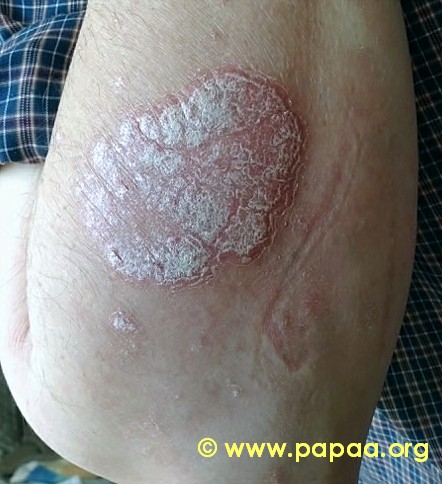 Innovative nanofiber patch for psoriasis treatment