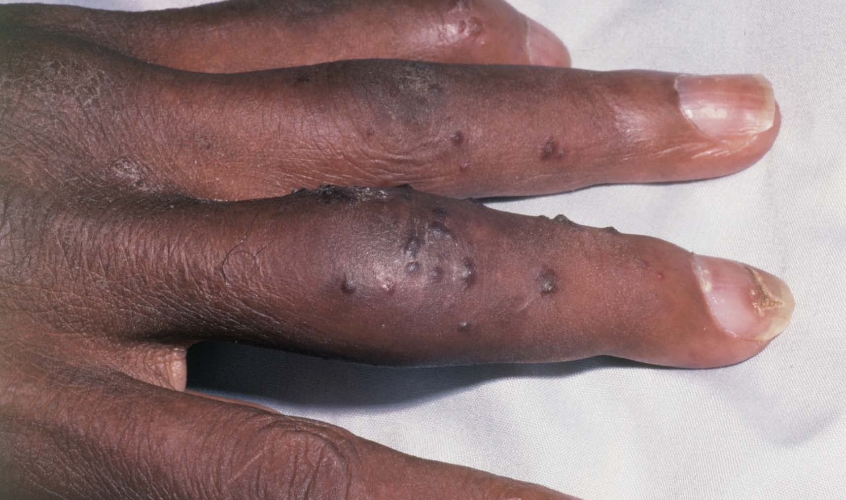 What questions should I ask about psoriatic arthritis?